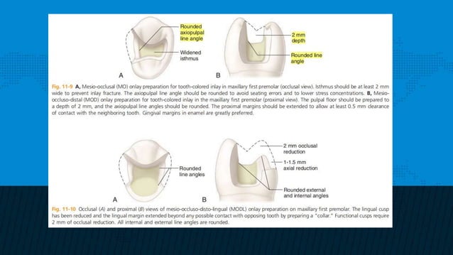 Retention and resistance forms of cavity design | PPTX | Dental Health ...