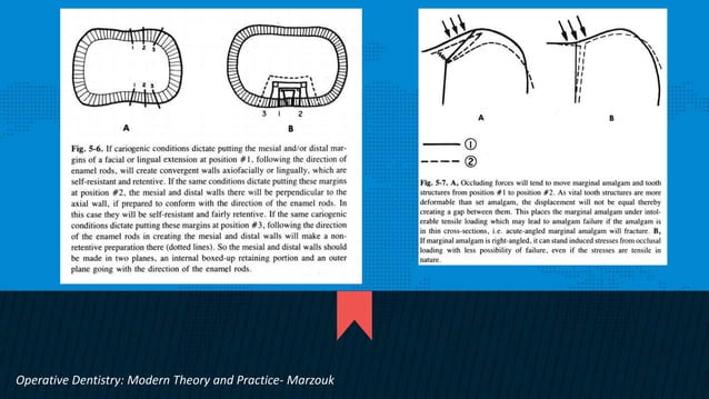 Retention and resistance forms of cavity design | PPTX | Dental Health ...