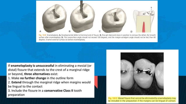 Retention and resistance forms of cavity design | PPTX | Dental Health ...