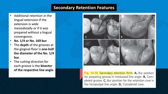 Retention and resistance forms of cavity design | PPTX | Dental Health ...