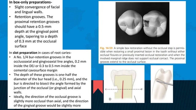 Retention and resistance forms of cavity design | PPTX | Dental Health ...