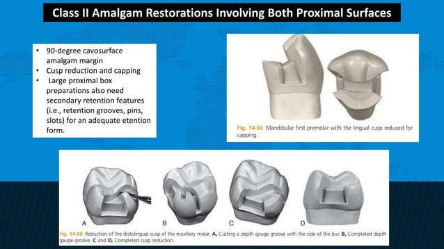 Retention and resistance forms of cavity design | PPTX | Dental Health ...