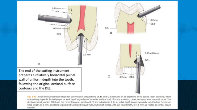 Retention and resistance forms of cavity design | PPTX | Dental Health ...