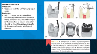 Retention and resistance forms of cavity design | PPTX
