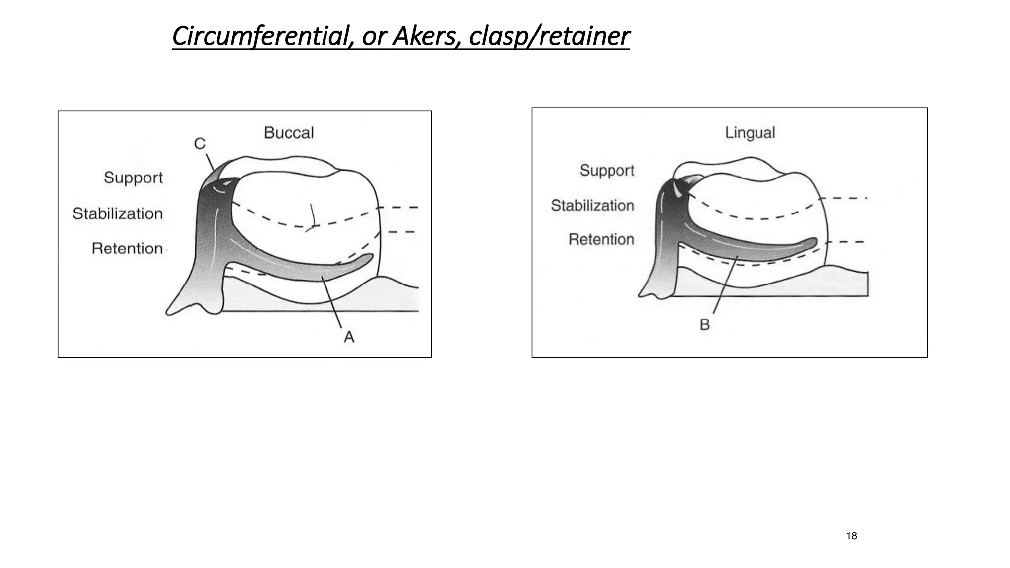 Retention and support in removable partial denture kalpana | PPTX
