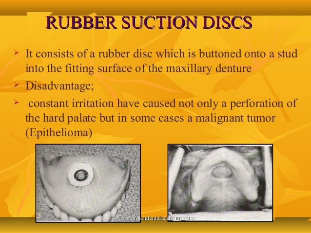 Retention in complete denture/ dental crown & bridge courses