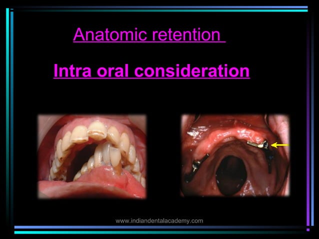 Retention in maxillofacial prosthesis copy | PPT | Ear, Nose and Throat ...