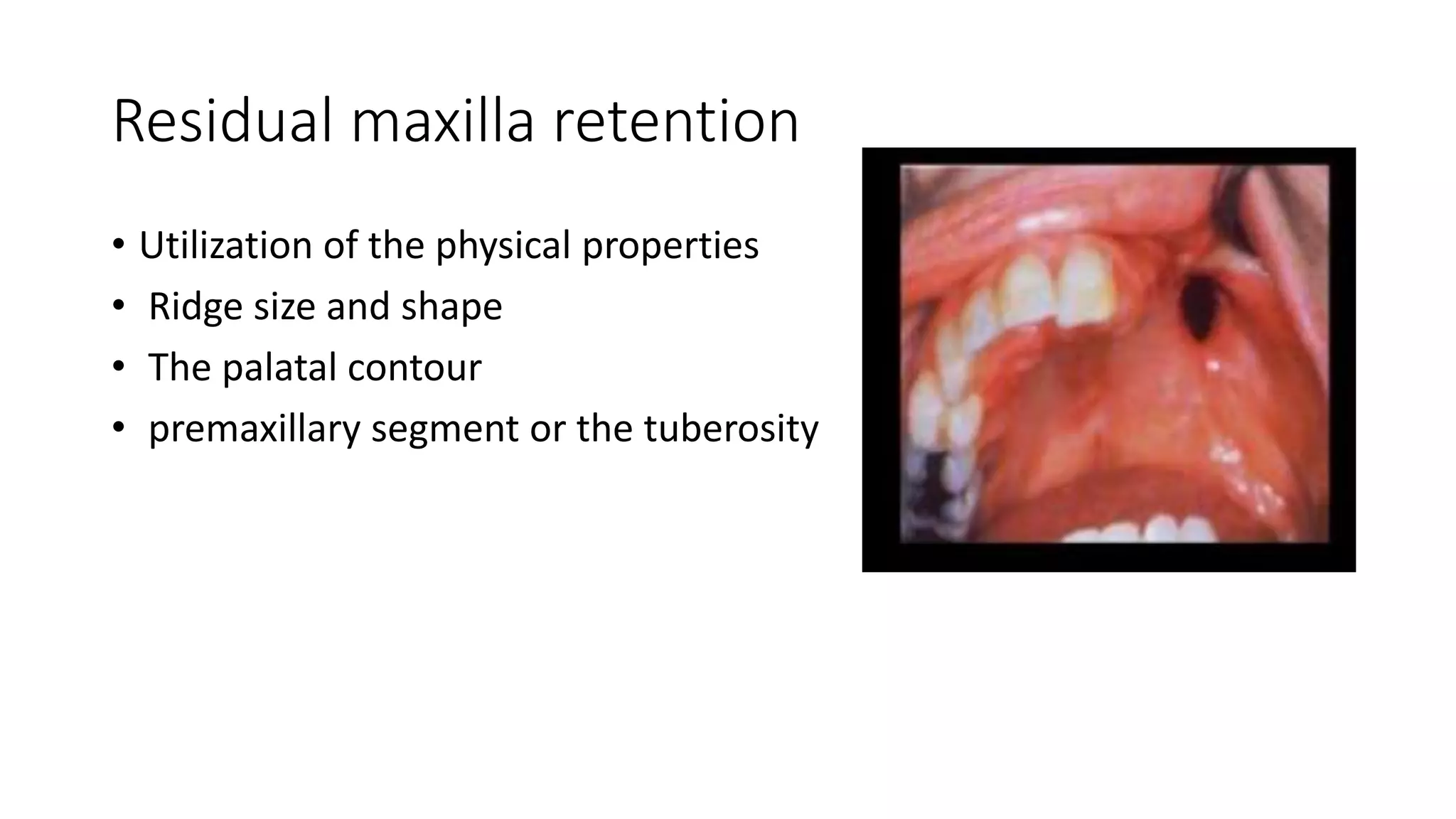 Retention in maxillofacial prosthesis pptx | PPTX