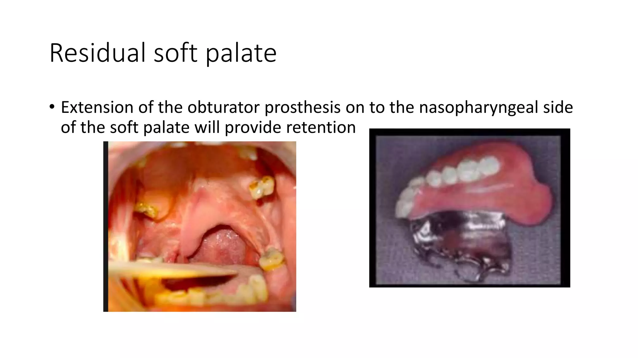 Retention in maxillofacial prosthesis pptx | PPTX
