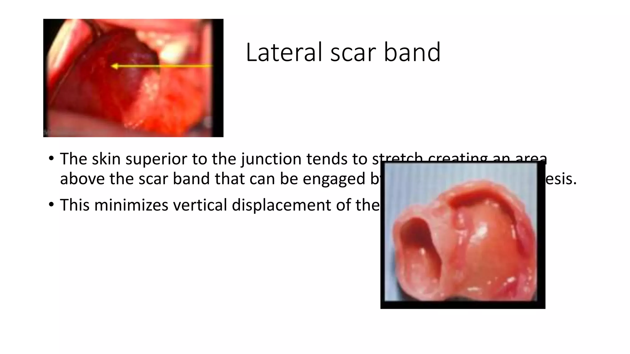 Retention in maxillofacial prosthesis pptx | PPTX