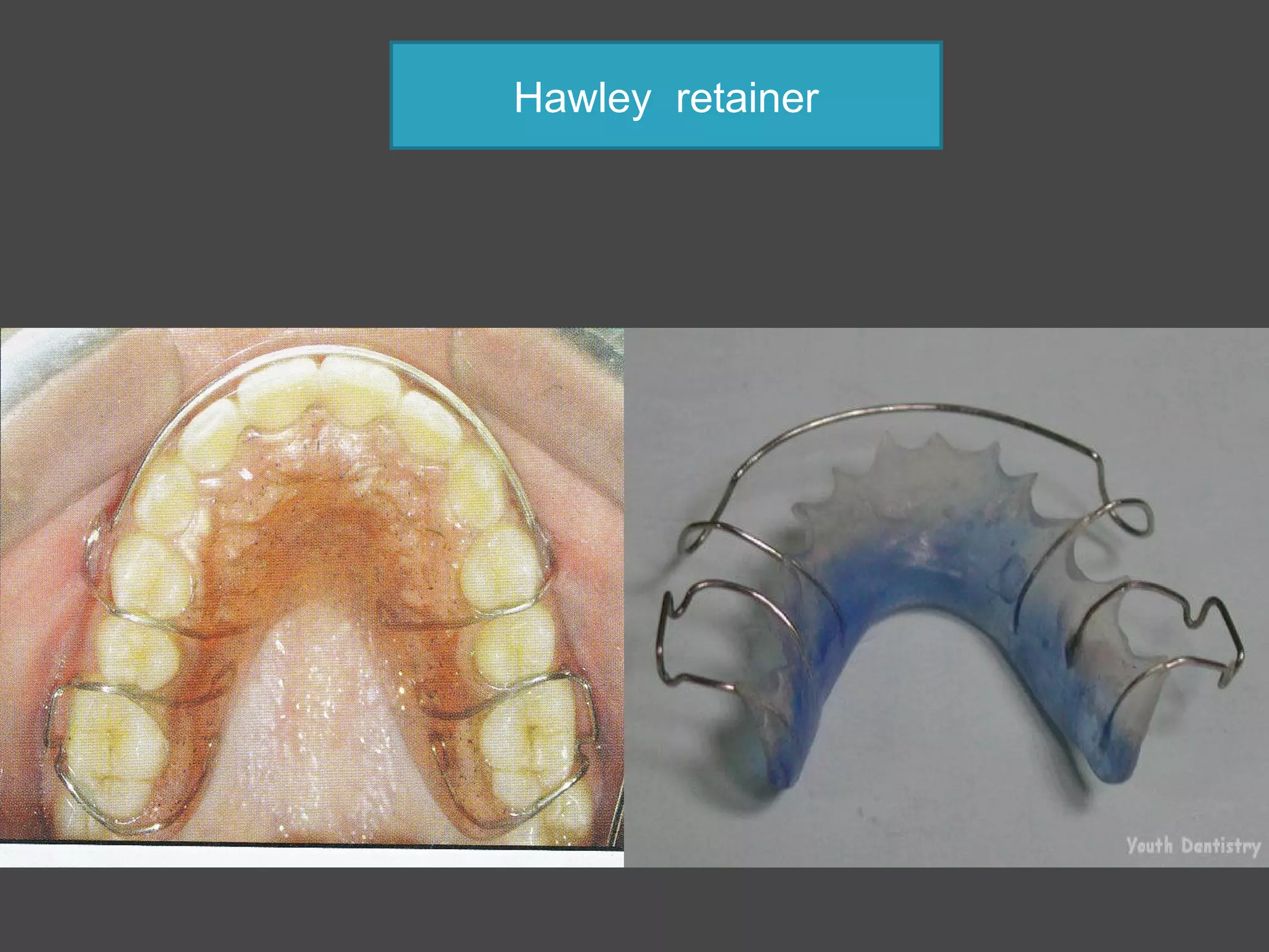 Retention in orthodontics | PPT