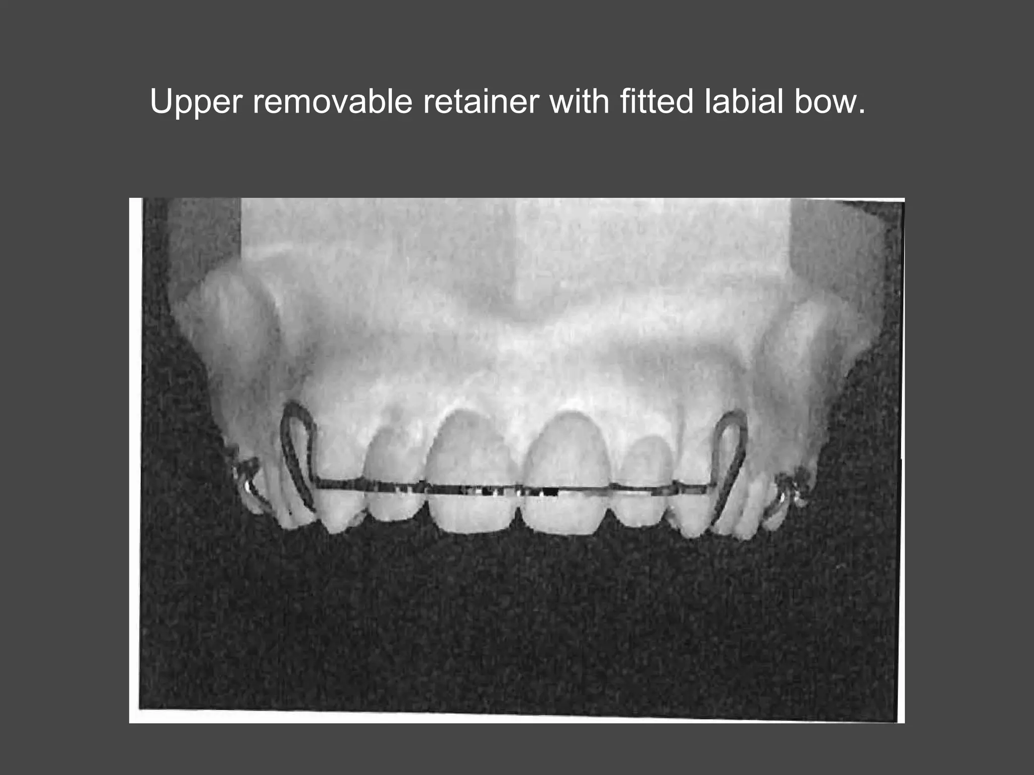 Retention in orthodontics | PPT