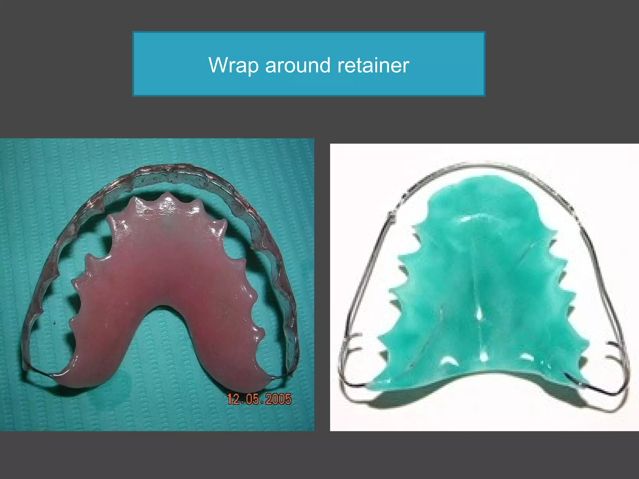 Retention in orthodontics | PPT