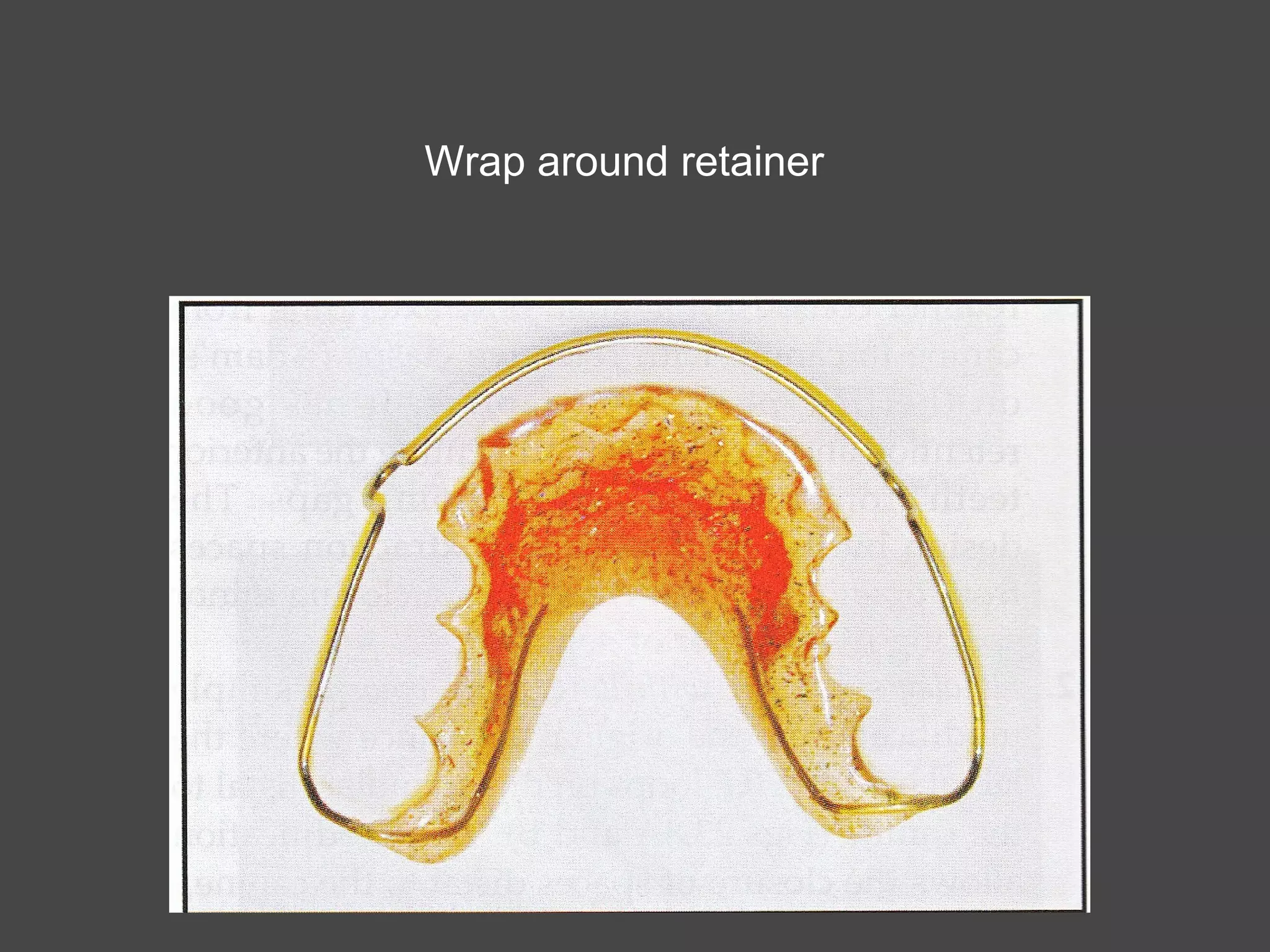 Retention in orthodontics | PPT