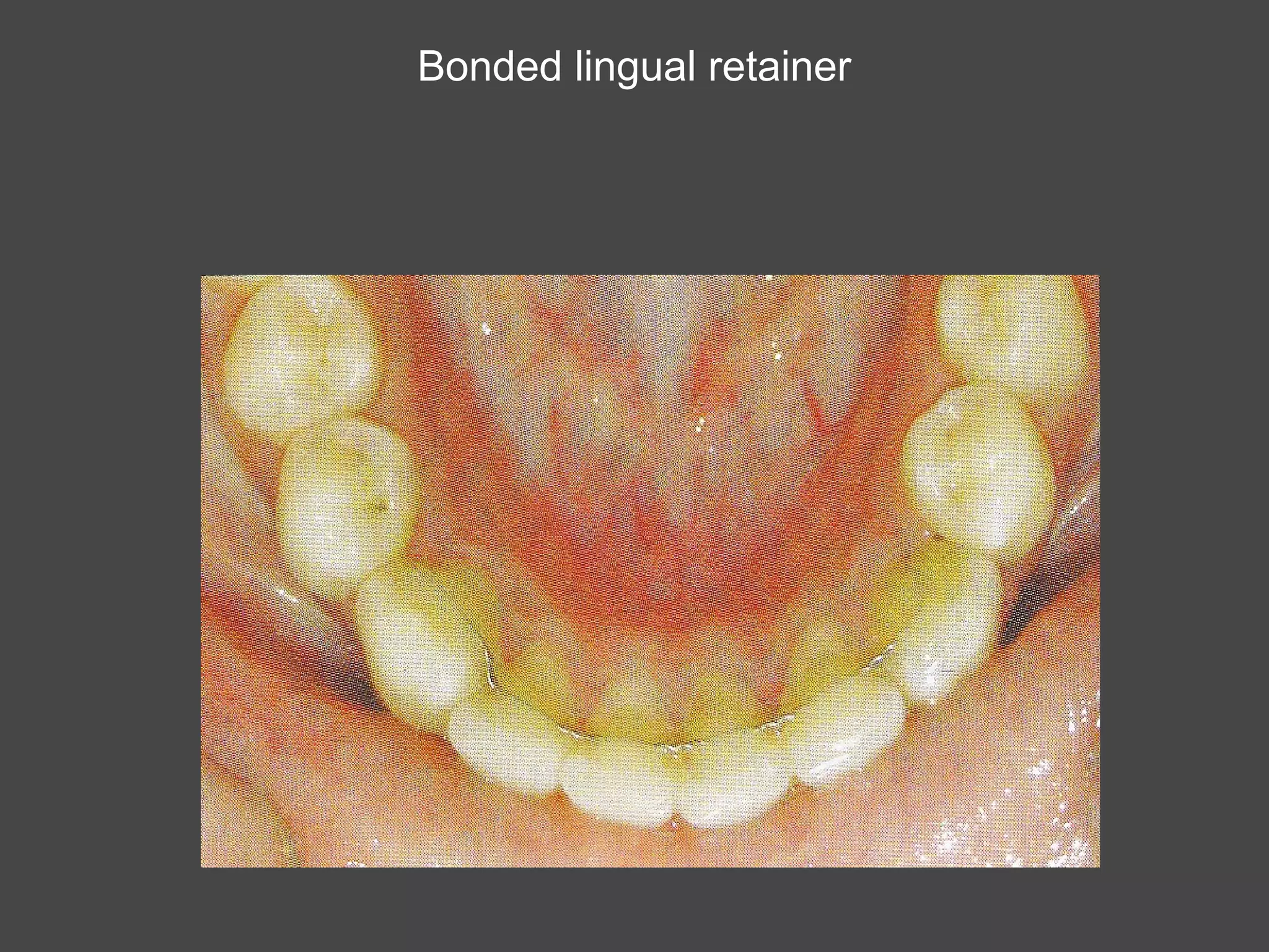Retention in orthodontics | PPT