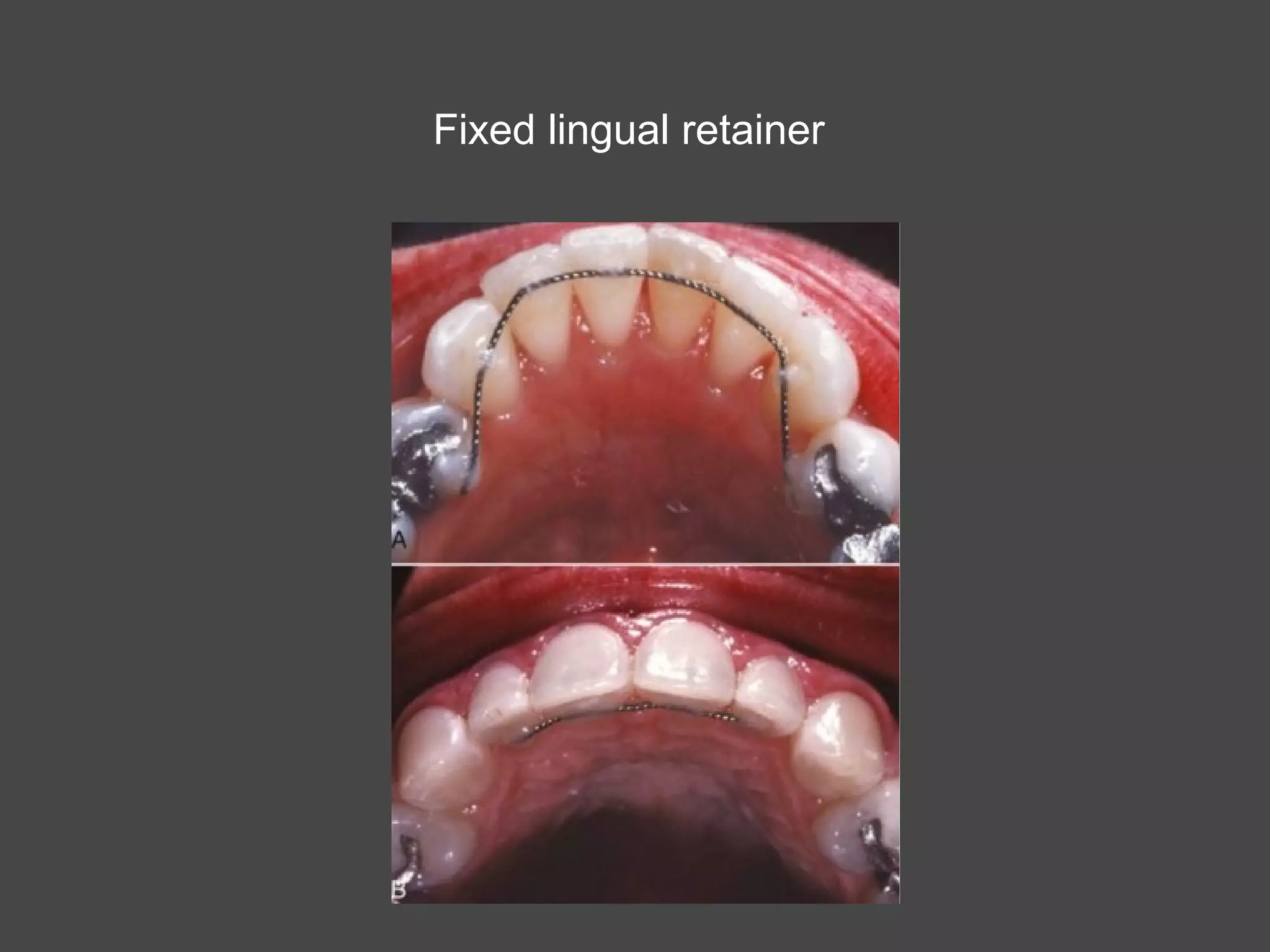 Retention in orthodontics | PPT