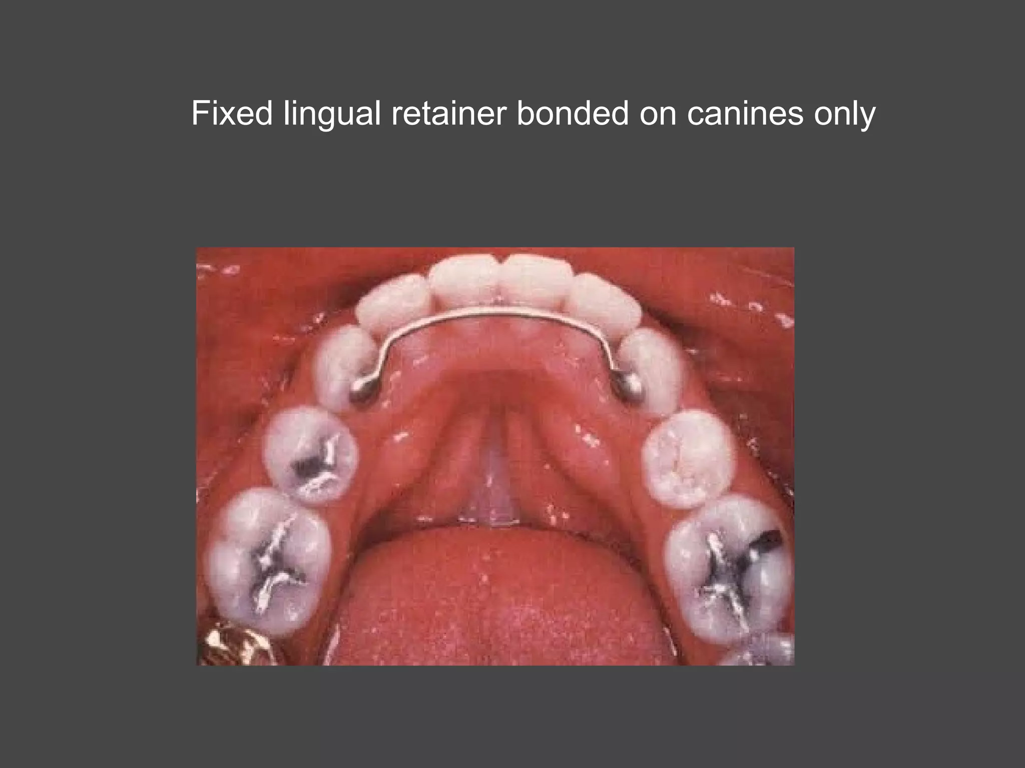 Retention in orthodontics | PPT