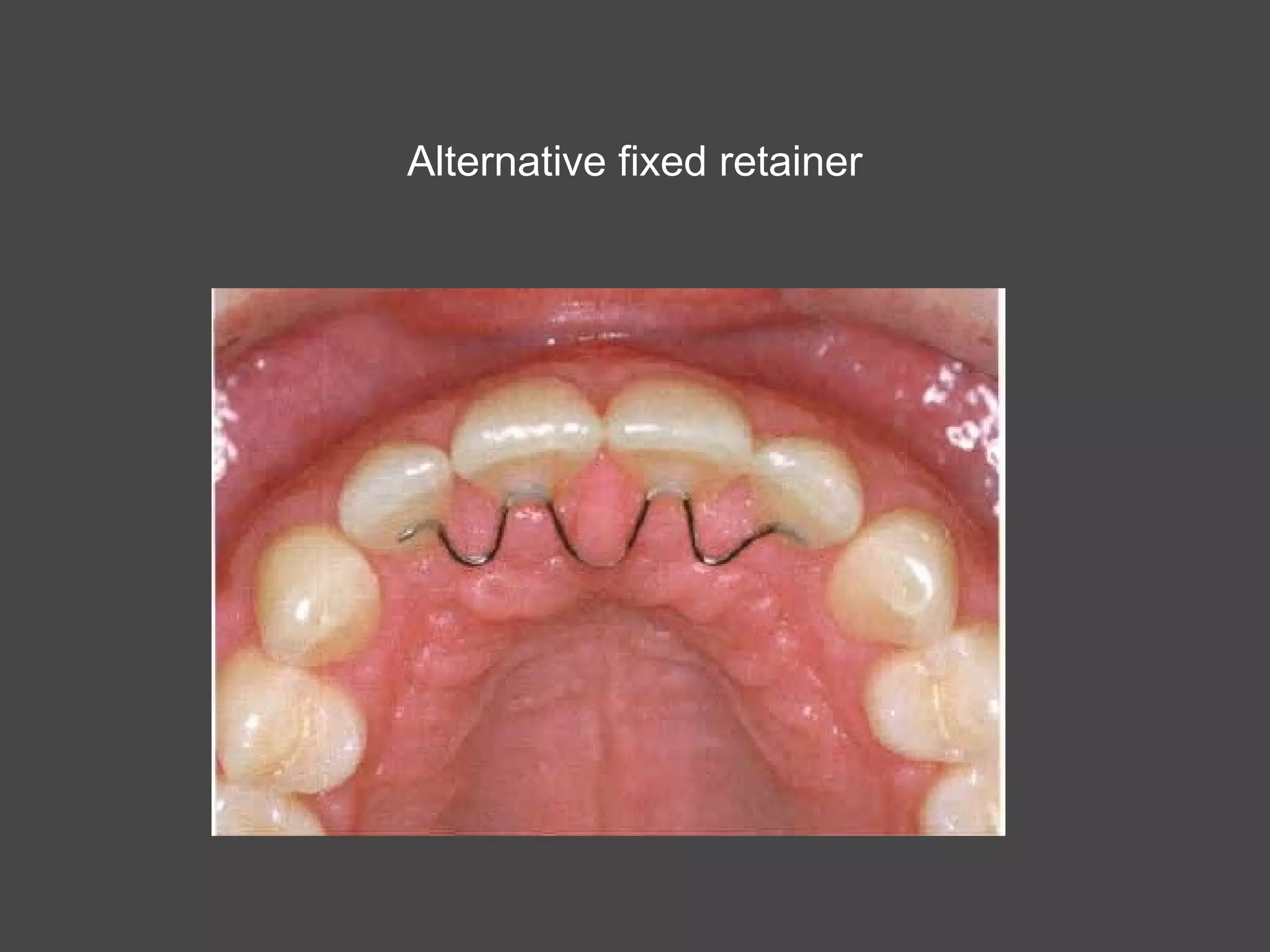 Retention in orthodontics | PPT