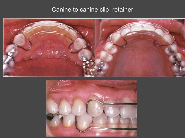 Retention in orthodontics | PPT