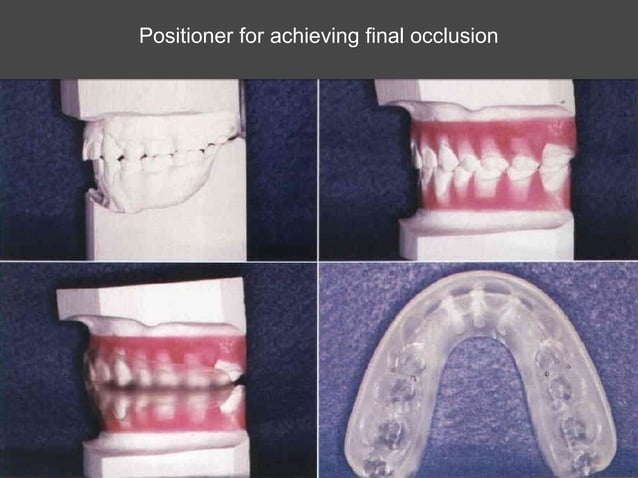 Retention in orthodontics | PPT