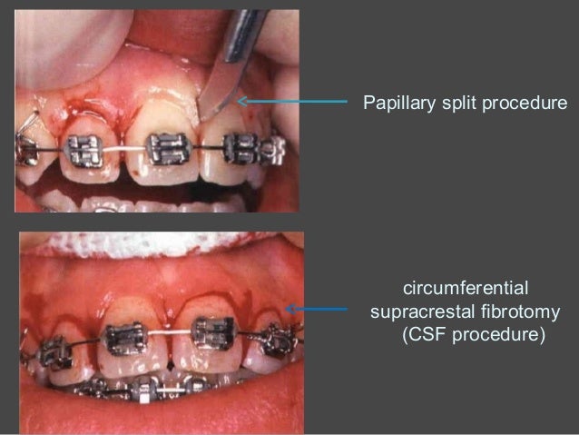 Retention in orthodontics