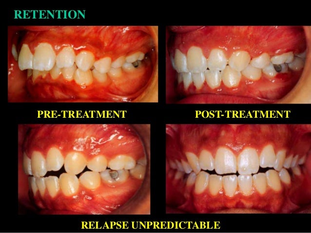 Retention /certified fixed orthodontic courses by Indian dental acad…