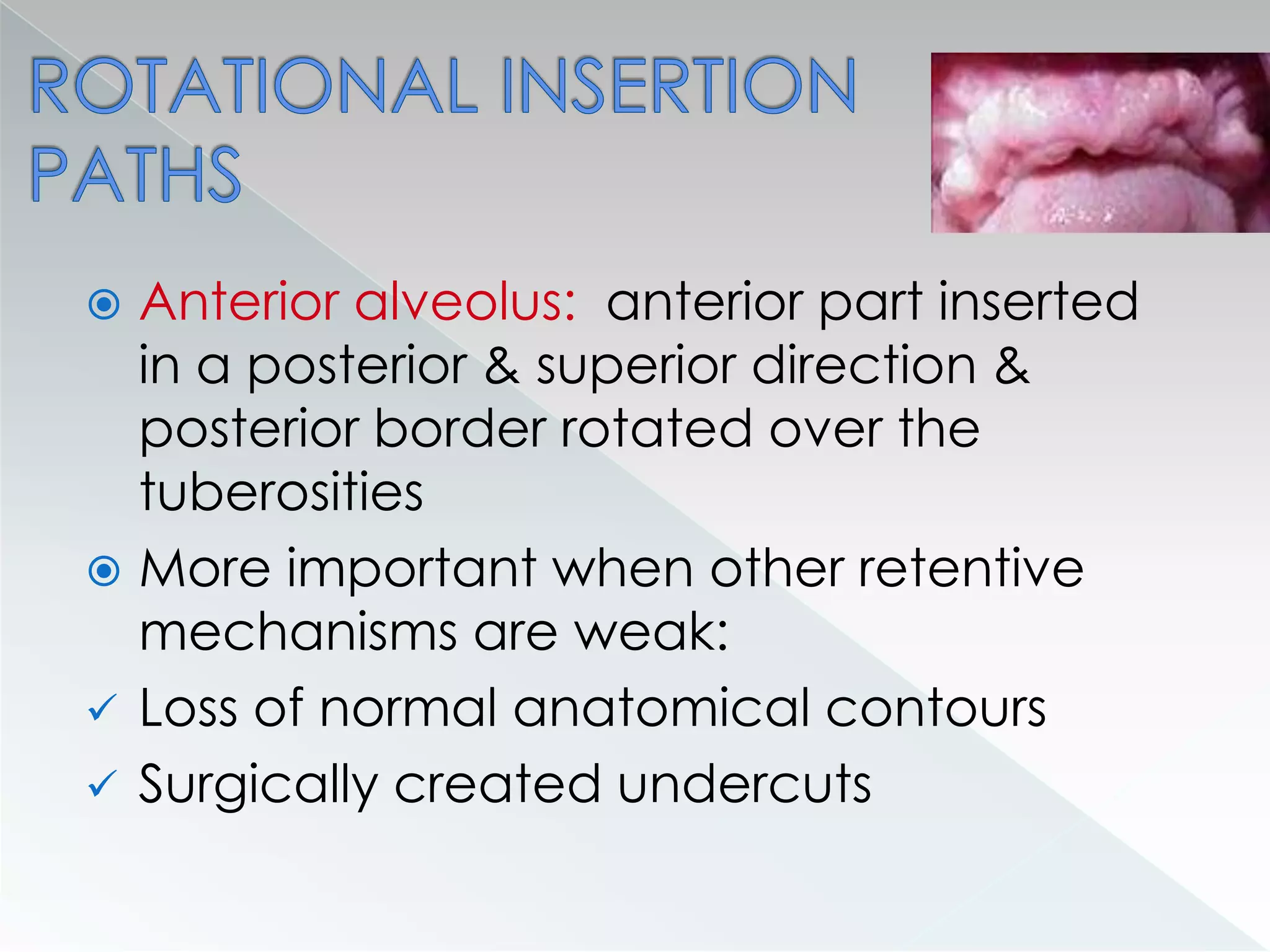 Retention of complete dentures | PPTX