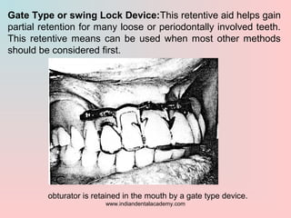 Retention of maxillofacial prosthesis/cosmetic dentistry courses | PPT
