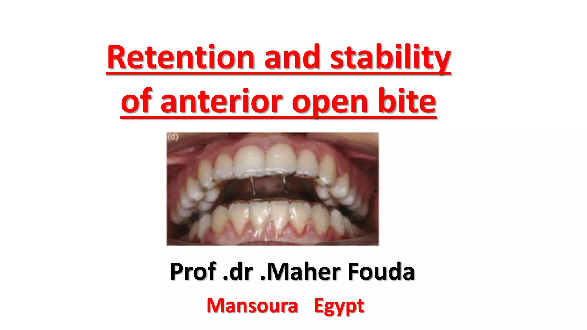 Retention of open bite | PPTX