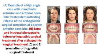 Retention of open bite | PPTX