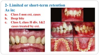 Retention & relapce in orthodontics.pptx