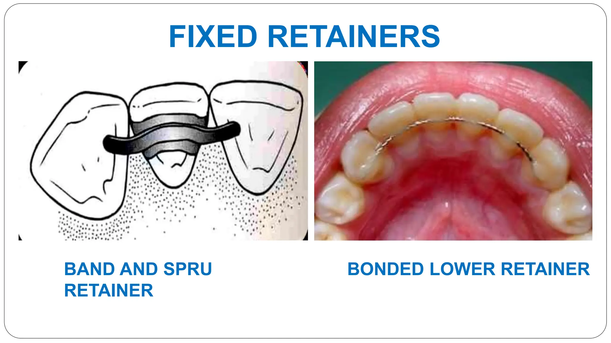 Retention & relapce in orthodontics | PPTX
