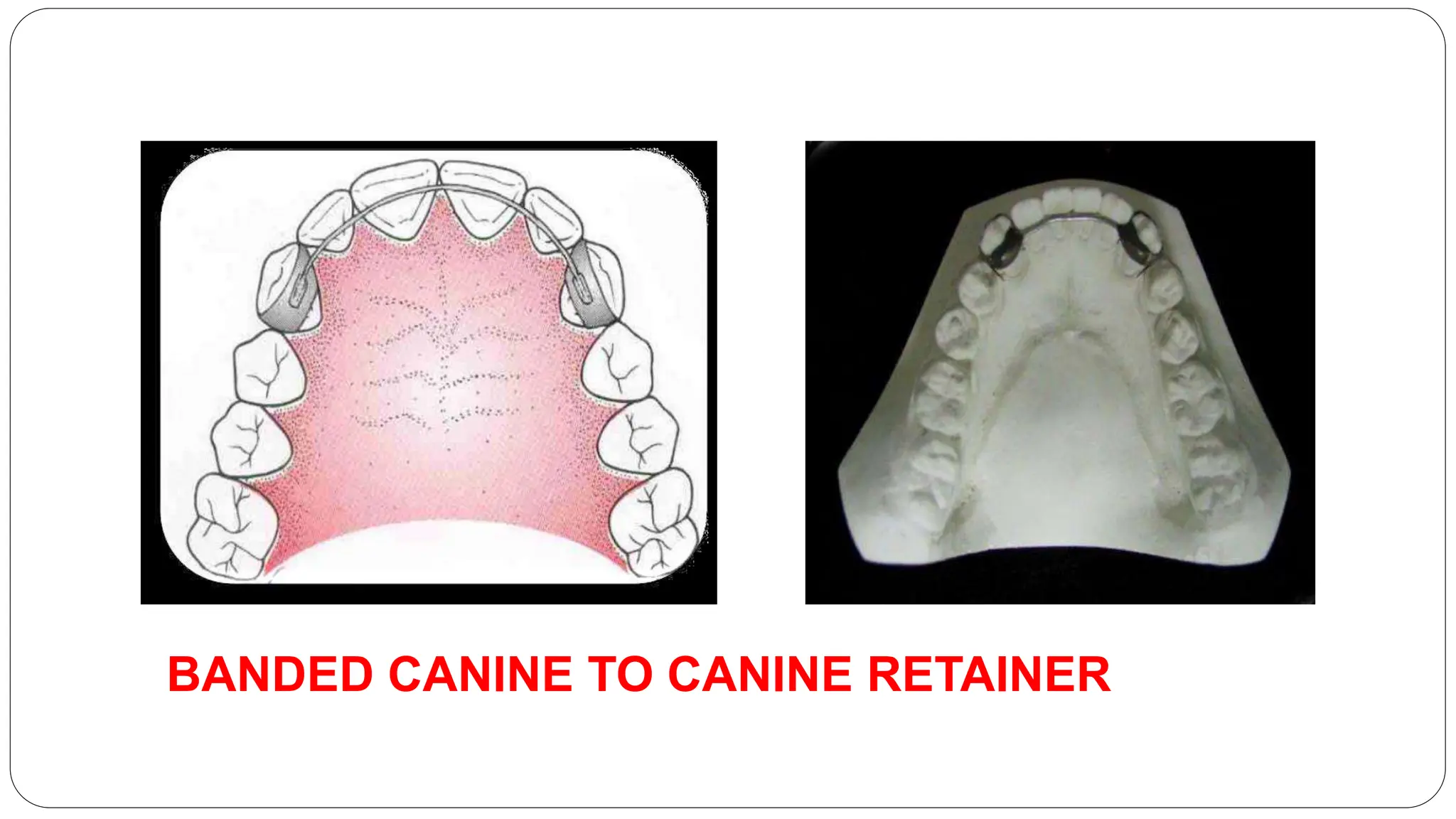 Retention & relapce in orthodontics | PPTX
