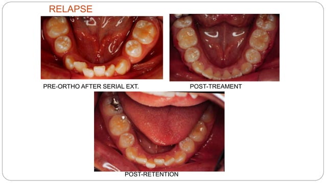 Retention & relapce in orthodontics | PPTX | Dental Health | Diseases ...