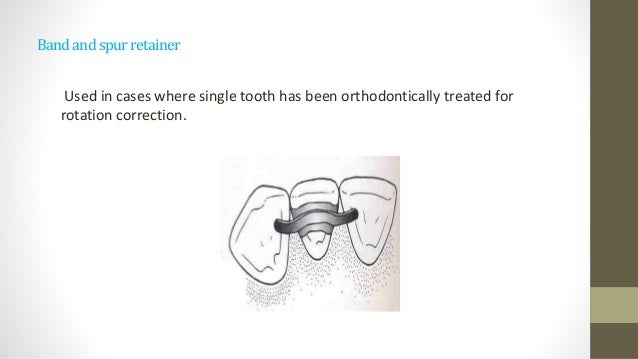 Retention & relapse in orthodontics