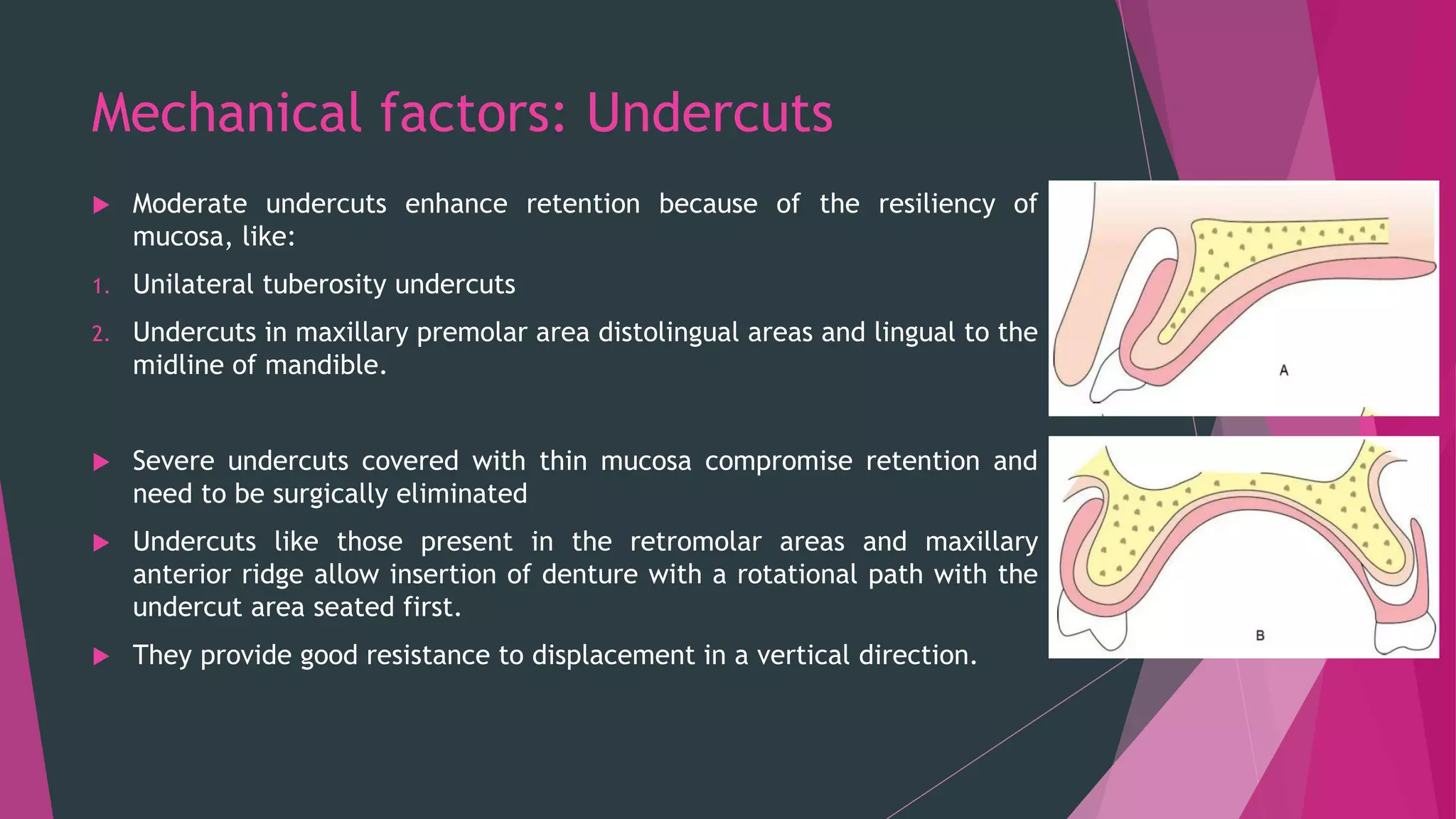 Retention, Stability and Support in Complete Dentures | PDF