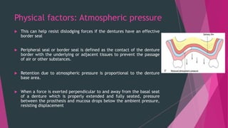 Retention, Stability and Support in Complete Dentures | PDF