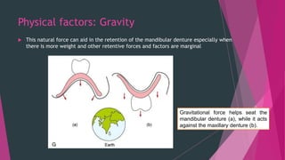 Retention, Stability and Support in Complete Dentures | PDF