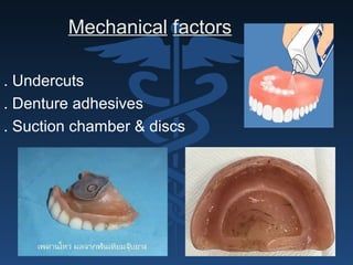 Retention stability support in complete dentures | PPT