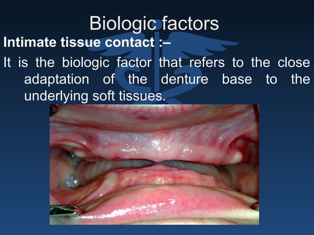 Retention stability support in complete dentures | PPT | Dental Health ...