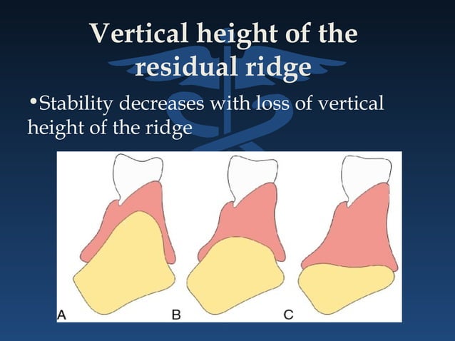 Retention stability support in complete dentures | PPT | Dental Health ...