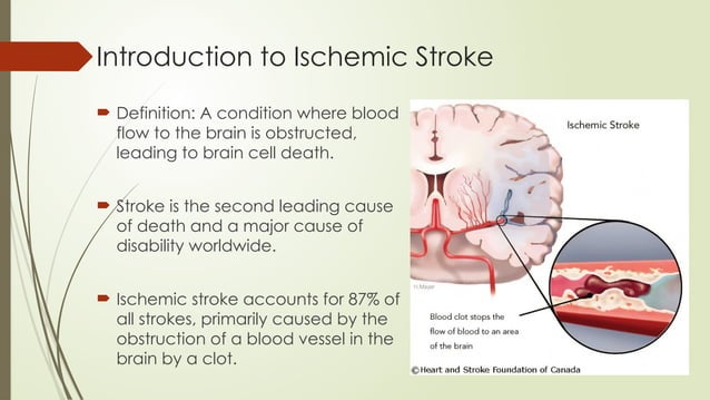 Reteplase Vs Alteplase in Ischaemic stroke.pptx