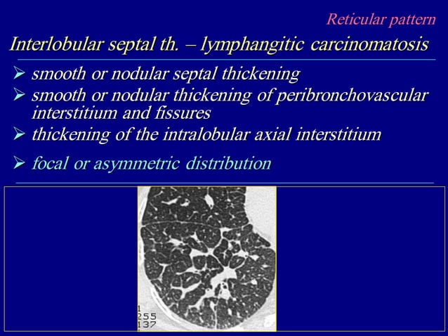 Reticular pattern | PDF | Lung and Respiratory Health | Diseases and ...