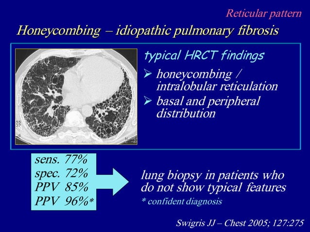 Reticular pattern | PDF | Lung and Respiratory Health | Diseases and ...