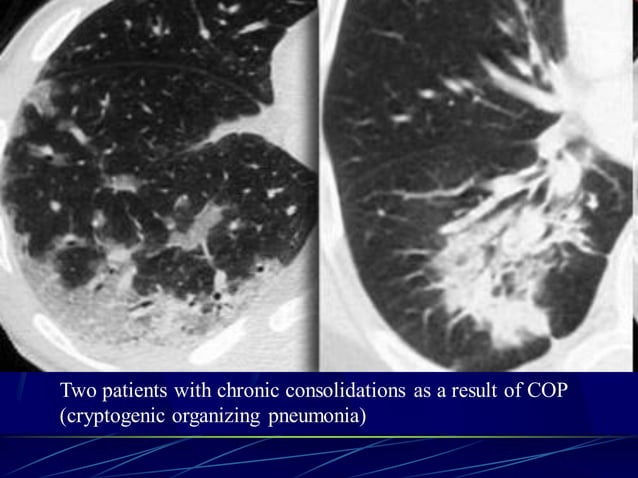 Reticular pattern | PDF | Lung and Respiratory Health | Diseases and ...