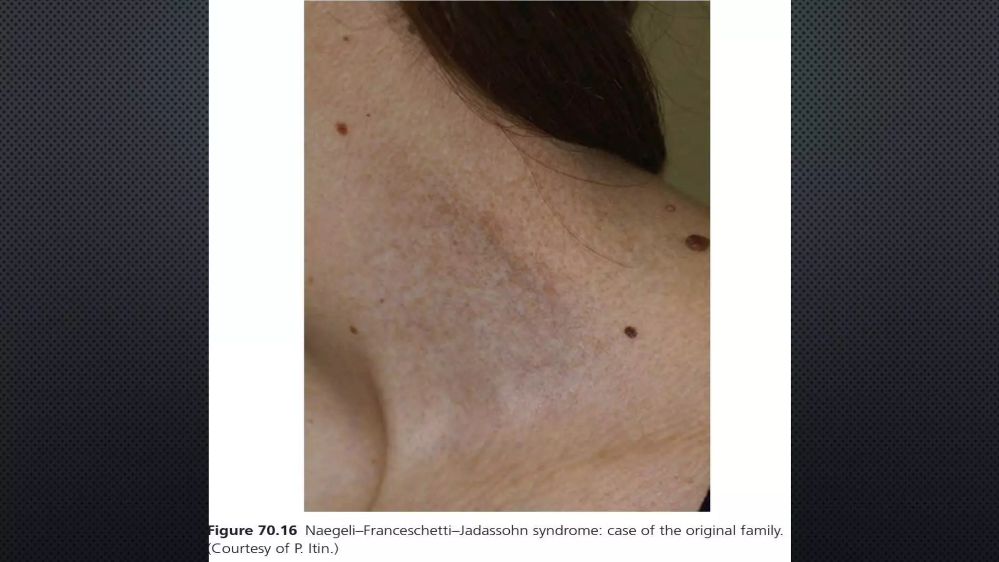 Reticulate Pigmentary disorders.pptx | Skin and Dermatology | Diseases ...