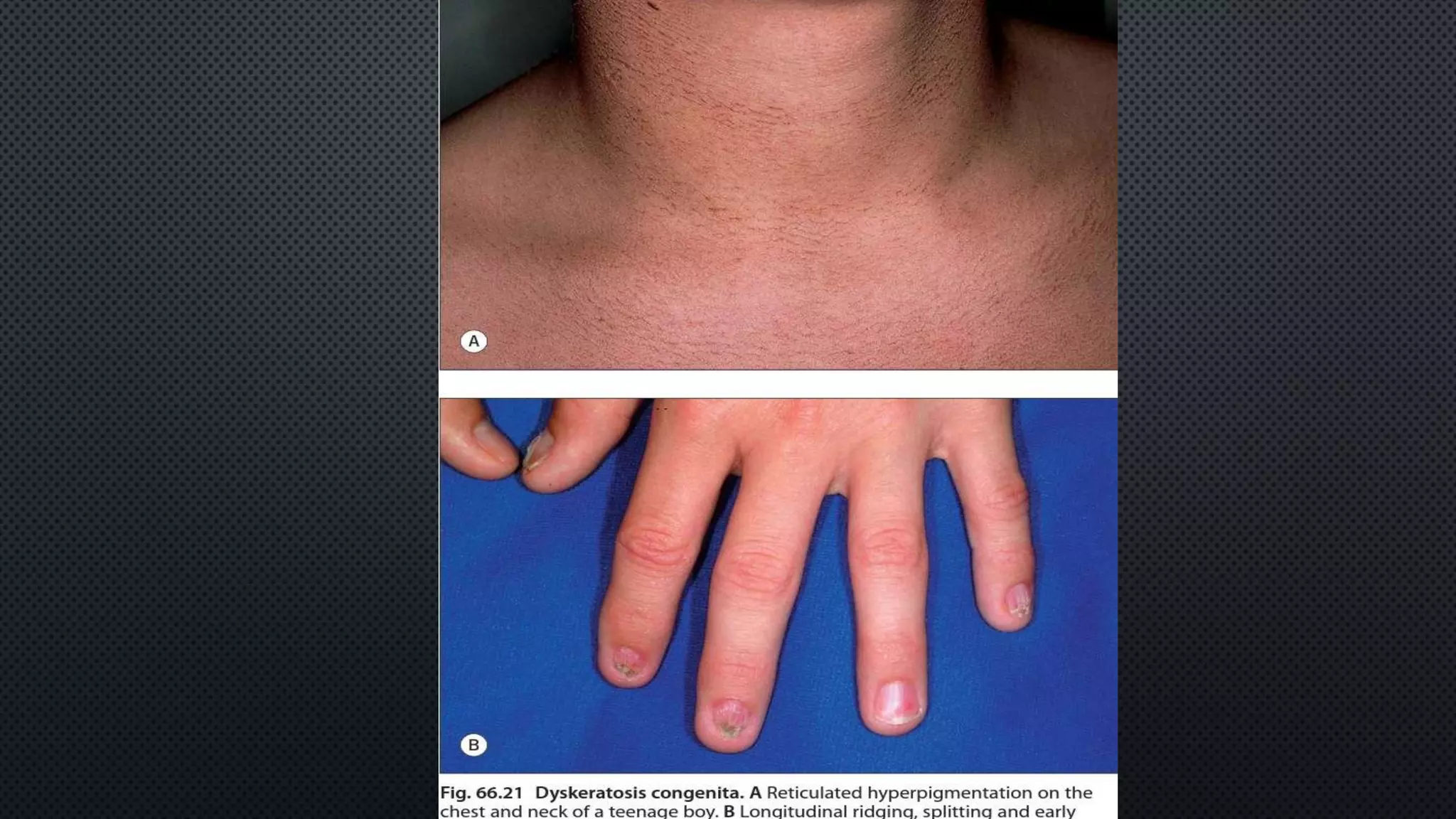 Reticulate Pigmentary disorders.pptx | Skin and Dermatology | Diseases ...