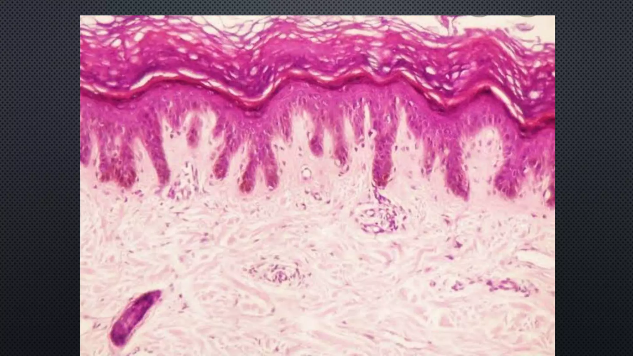 Reticulate Pigmentary disorders.pptx | Skin and Dermatology | Diseases ...