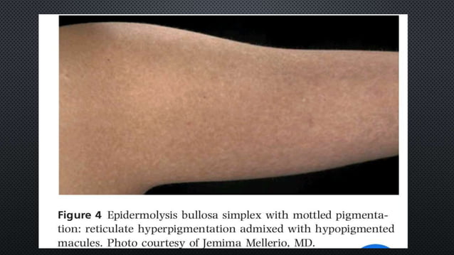 Reticulate Pigmentary disorders.pptx | Skin and Dermatology | Diseases ...