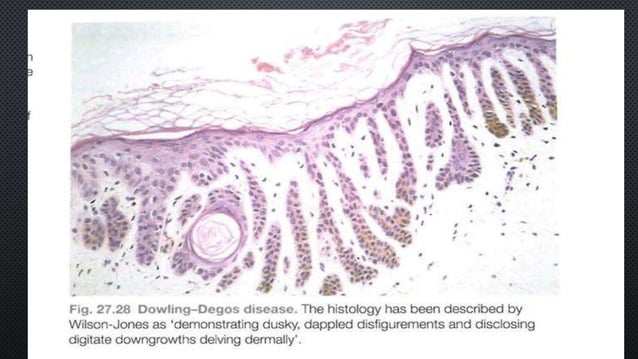 Reticulate Pigmentary disorders.pptx | Skin and Dermatology | Diseases ...
